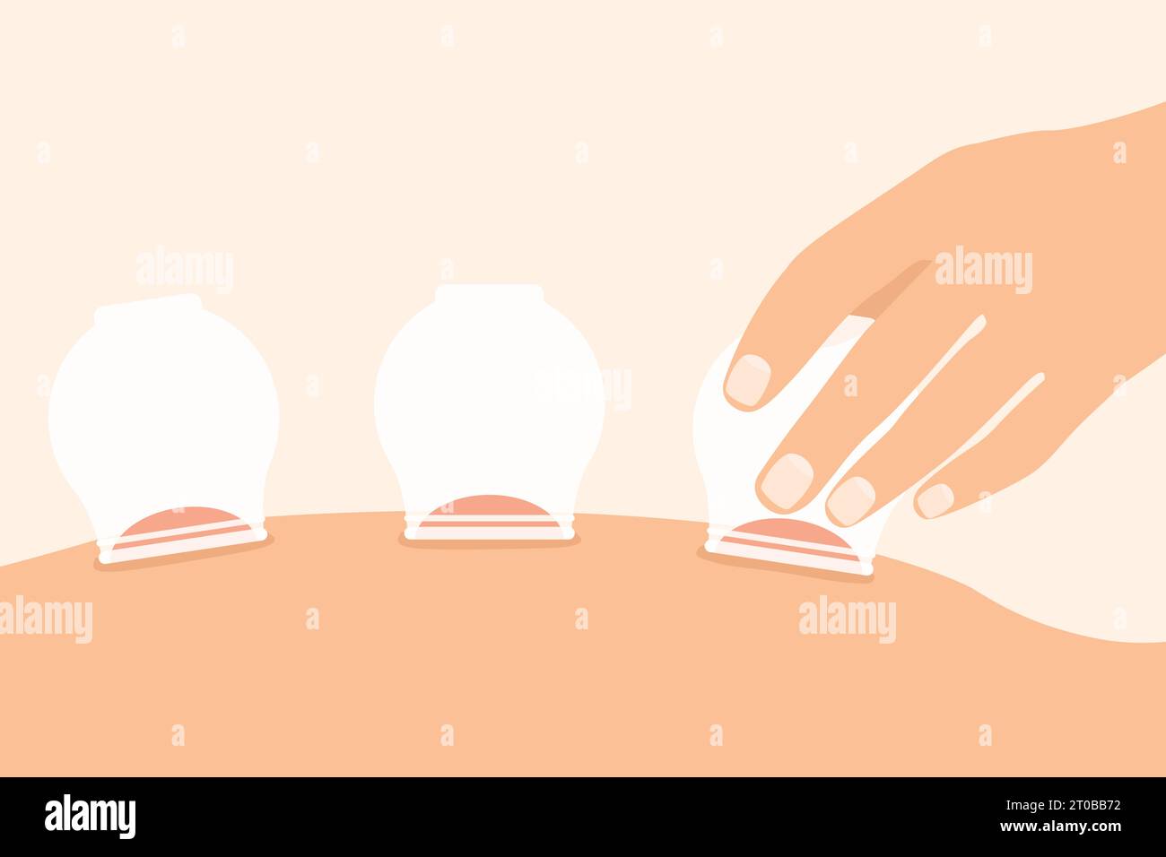 Fire cupping woman Stock Vector Images - Alamy