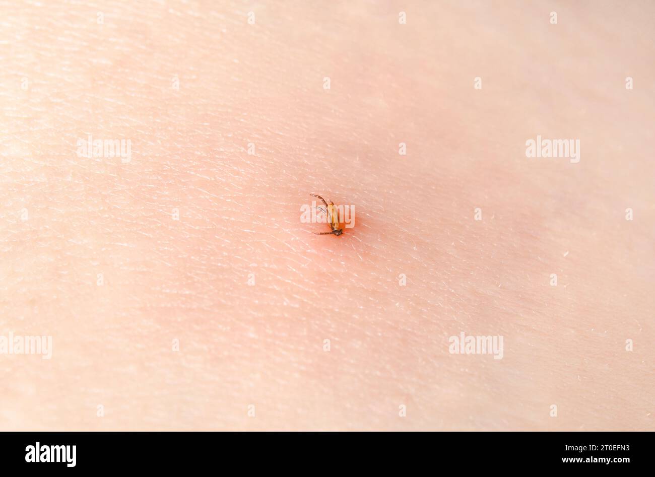 Tick on skin of woman after walk forest, close up. Castor bean tick ...