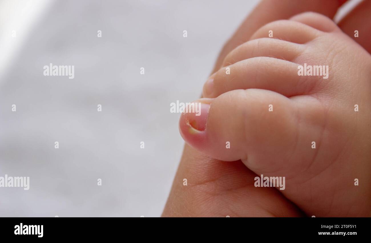 a baby, pus, a nail grew into a finger. Selective focus Stock Photo - Alamy