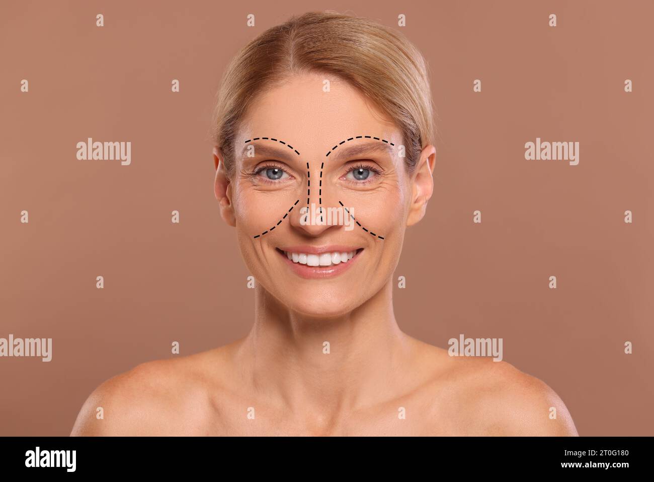 Woman with markings for cosmetic surgery on her face against light ...