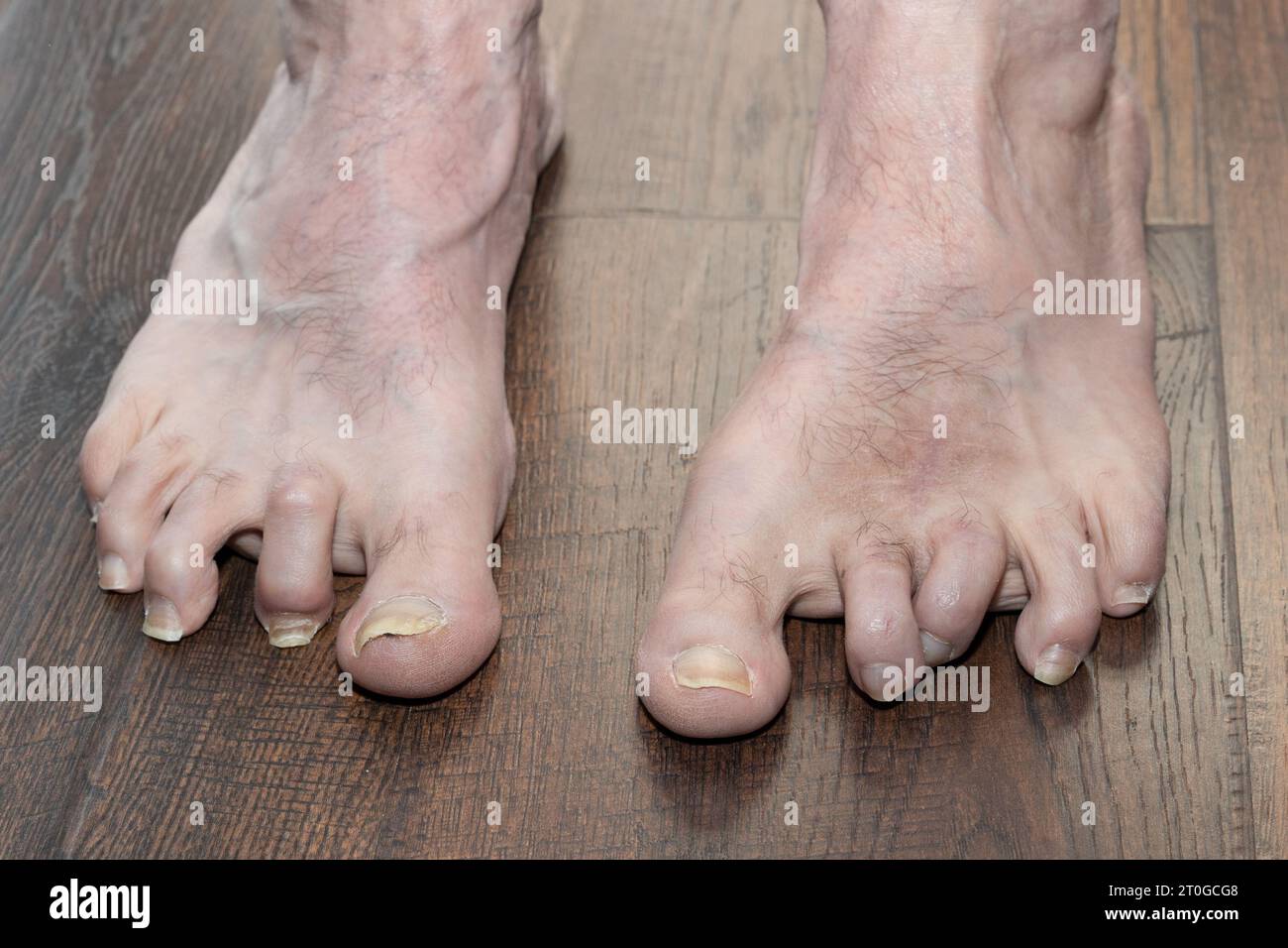 Deformed Feet From Heels