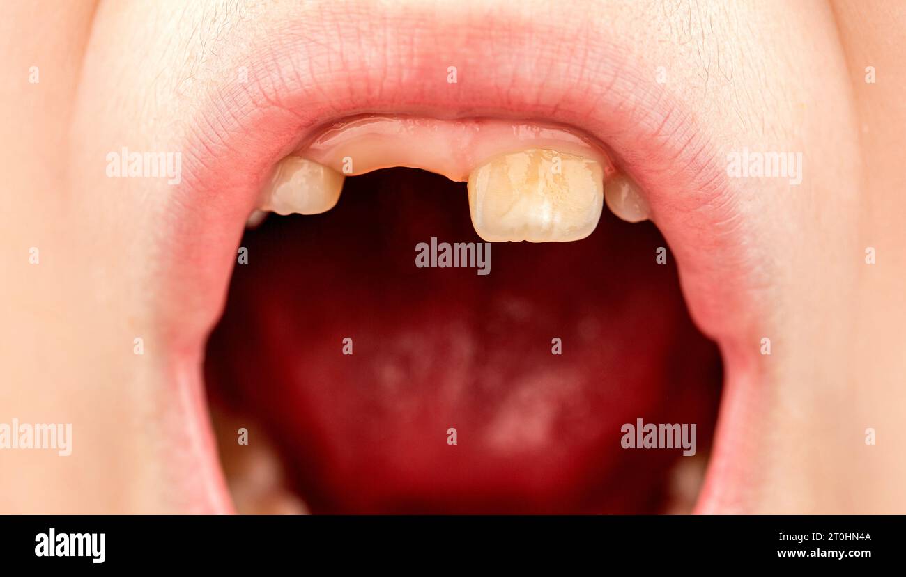 Bad teeth child. Portrait boy with bad teeth. Child smile and show her ...