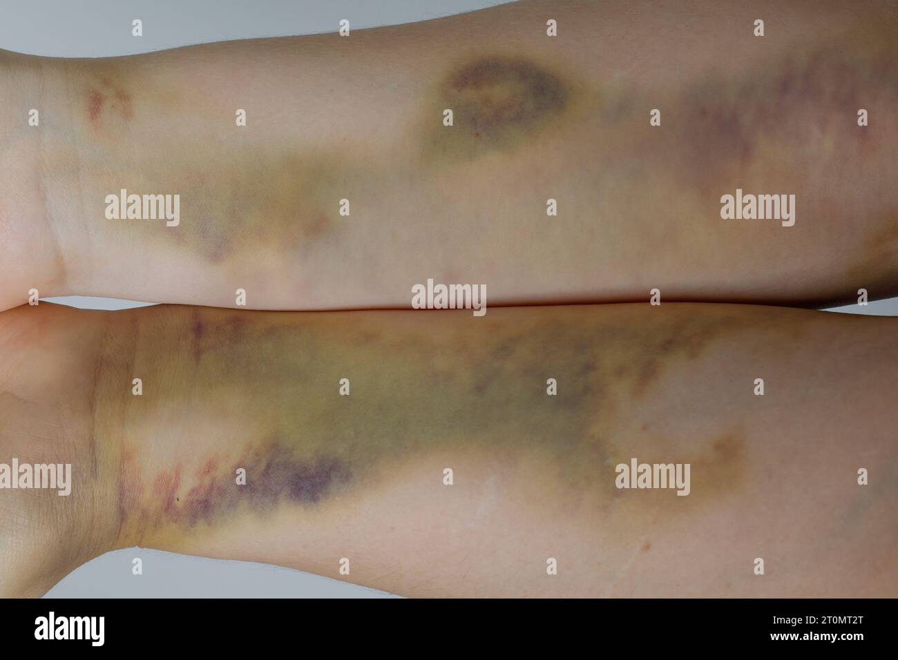 Bruised hands hi-res stock photography and images - Alamy