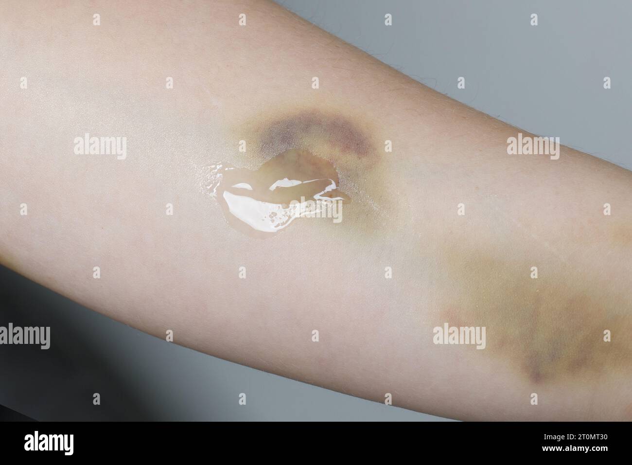 Medical gel ointment on female hand skin with bruise closeup Stock ...