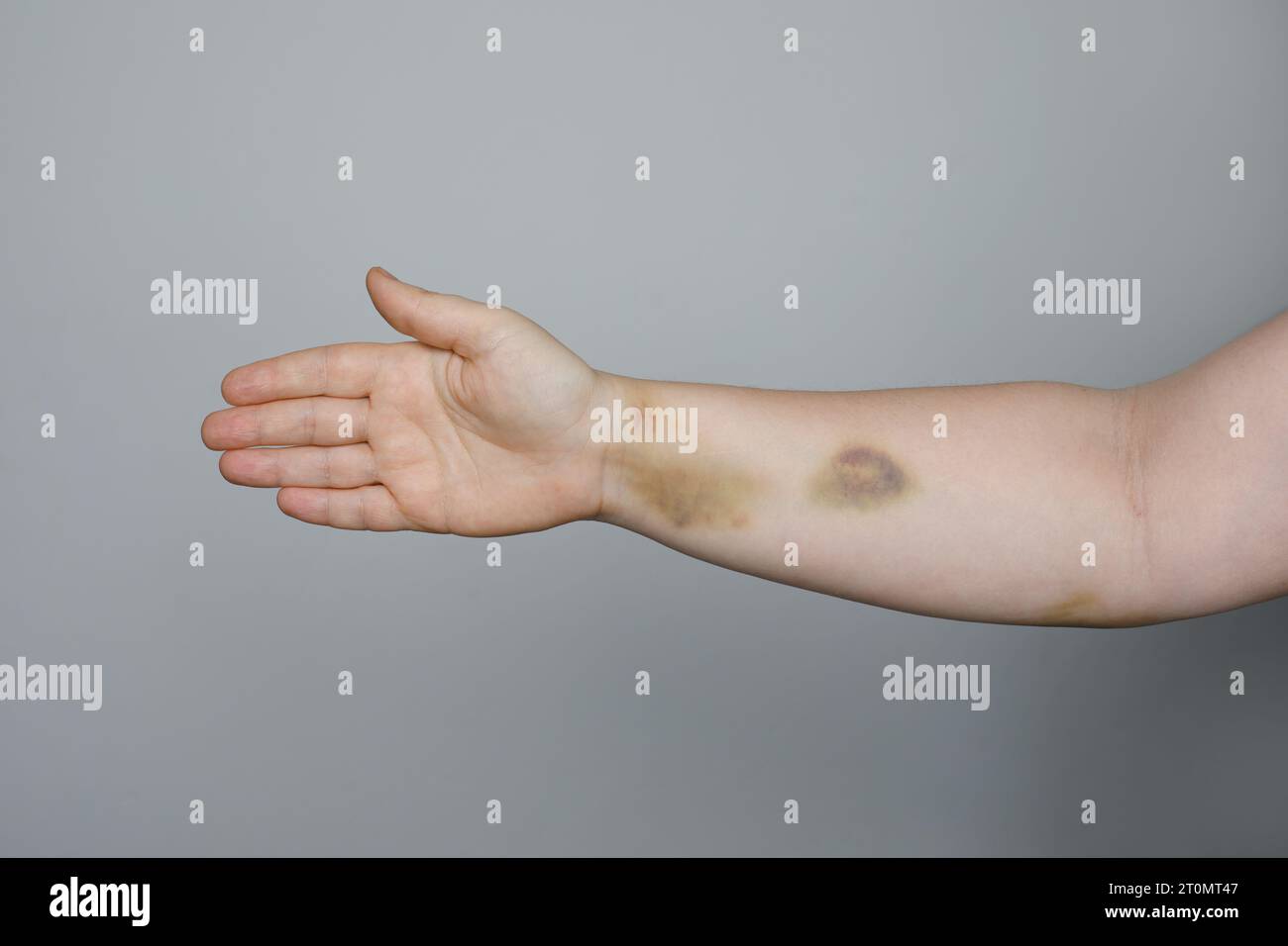 Large bruise on human arm. Injection bruises Stock Photo - Alamy