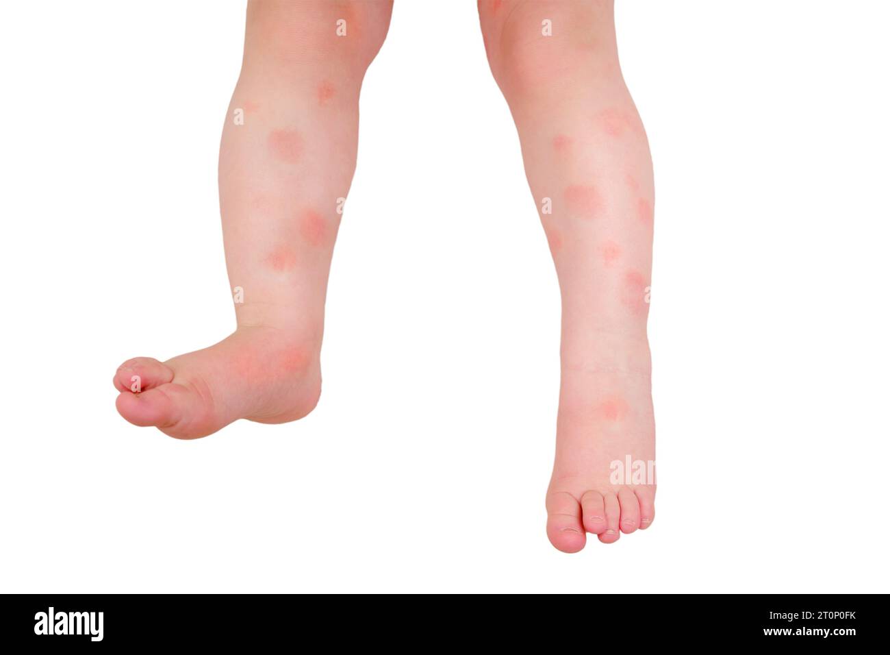 Toddler baby skin care, allergies and dermatitis, isolated on white ...