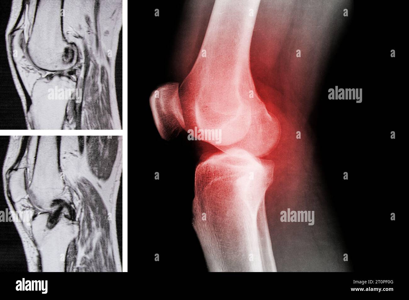 Magnetic resonance imaging and x-ray of the knee after removal of the ...