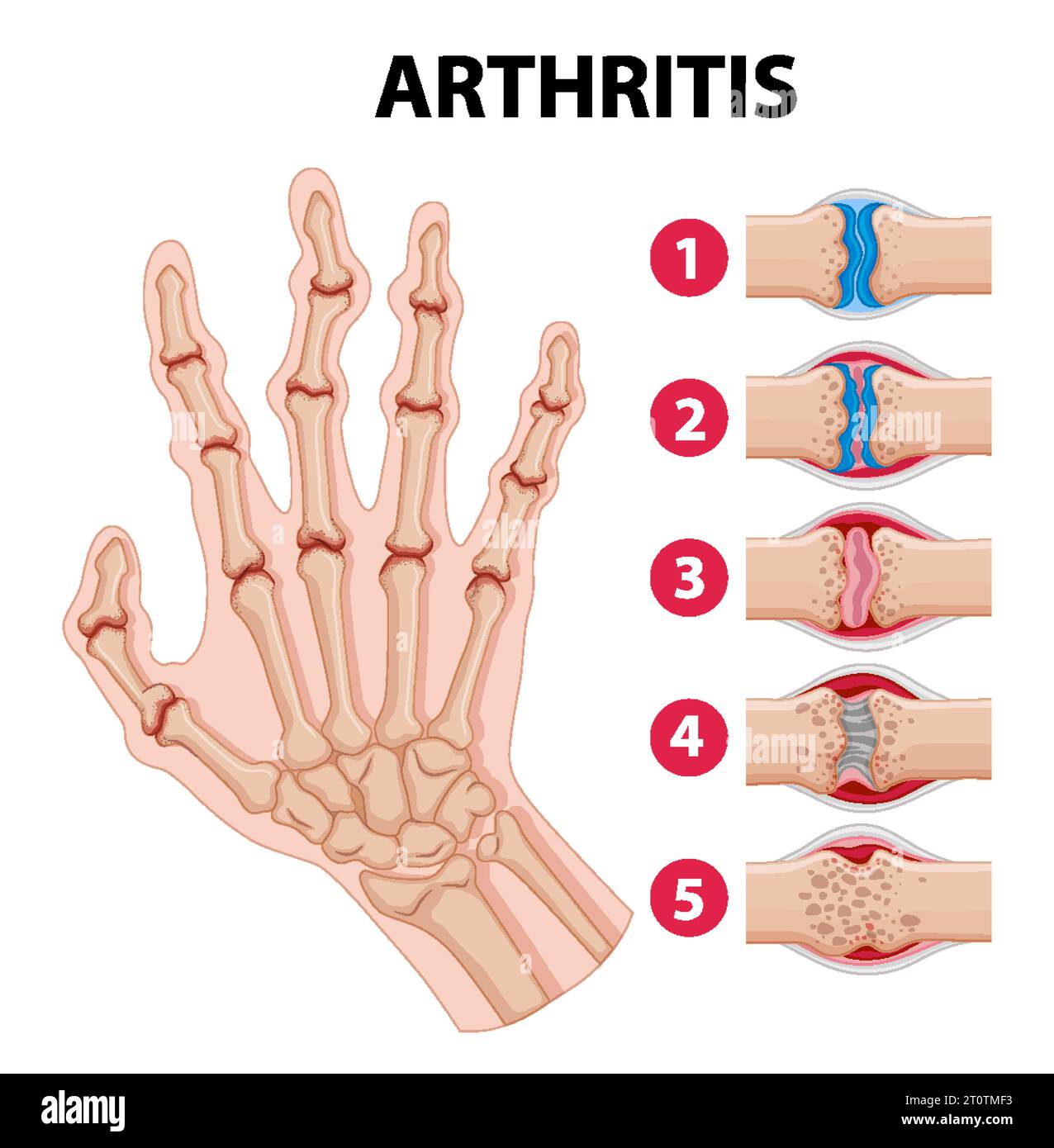 Illustration depicting the stages of arthritis in a human hand Stock ...