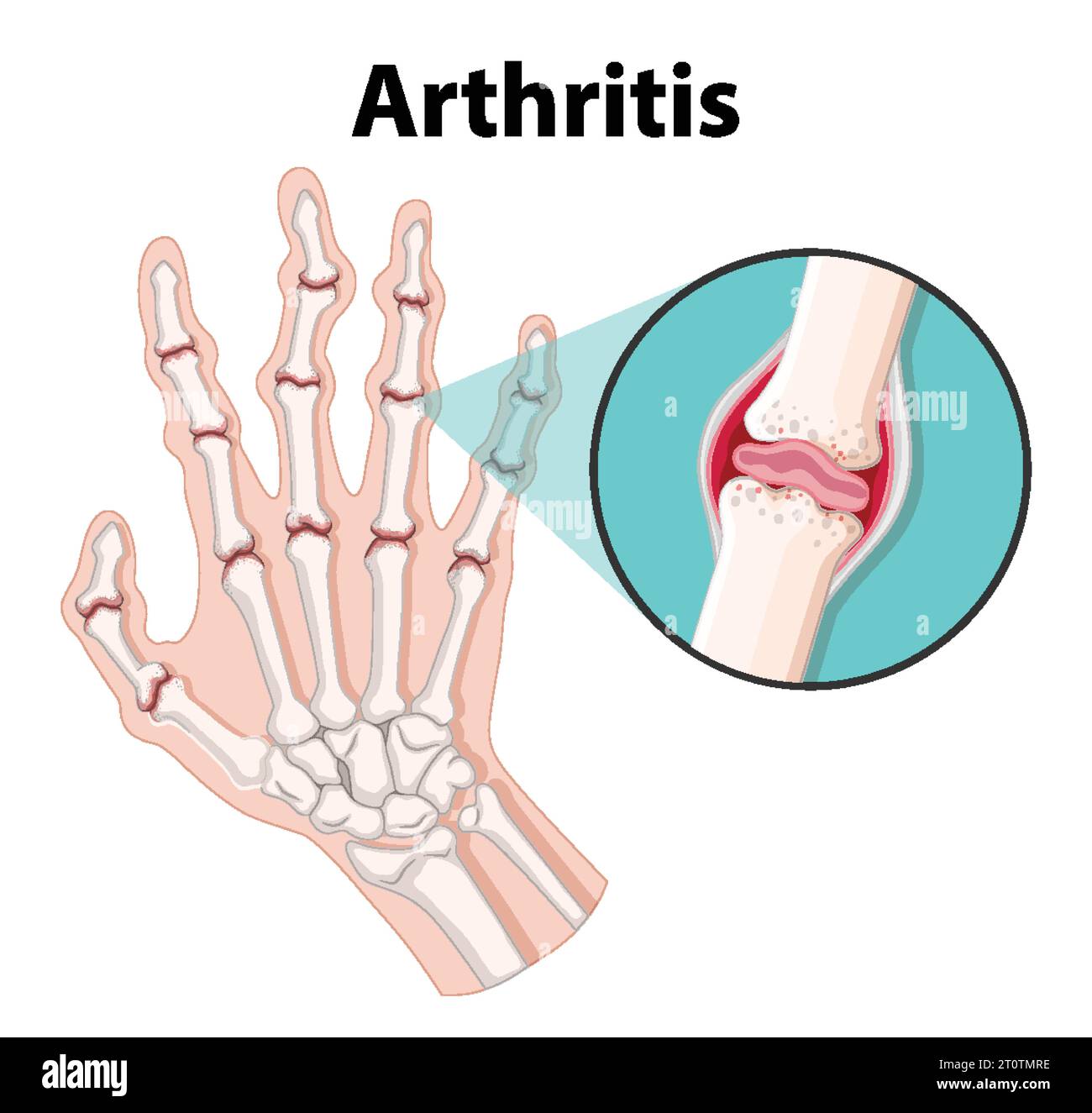 Learn about human anatomy and arthritis stages through a science ...
