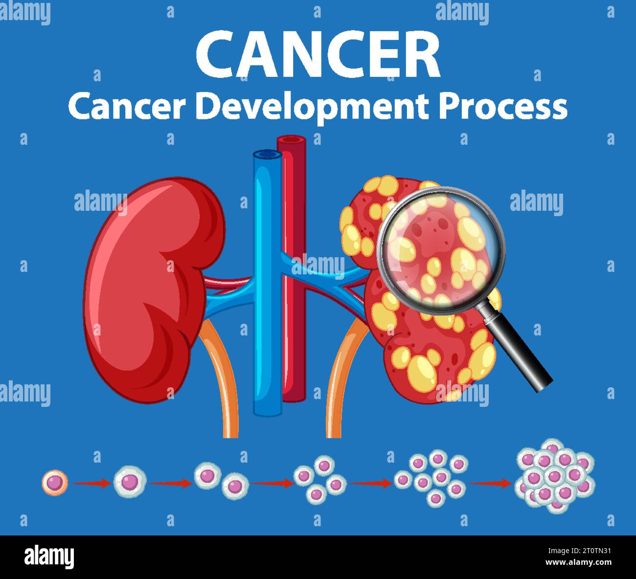 Illustrated infographic depicting the process of cancer development on ...
