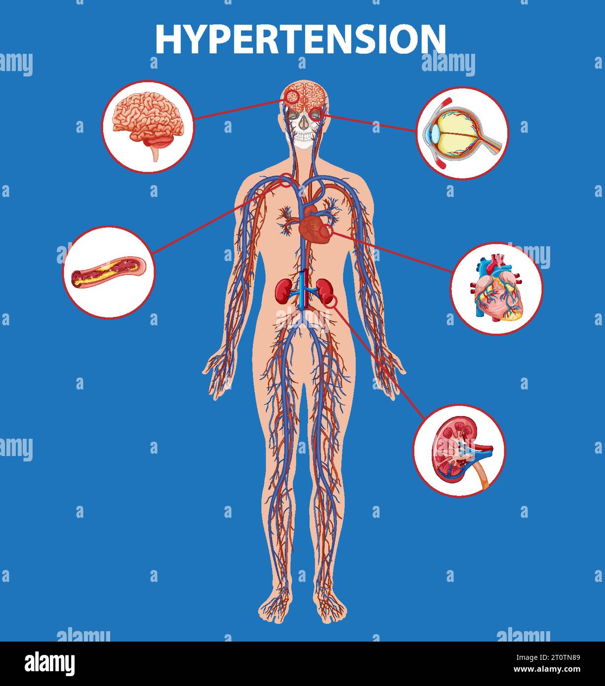 Illustration depicting the impact of hypertension on various body parts ...