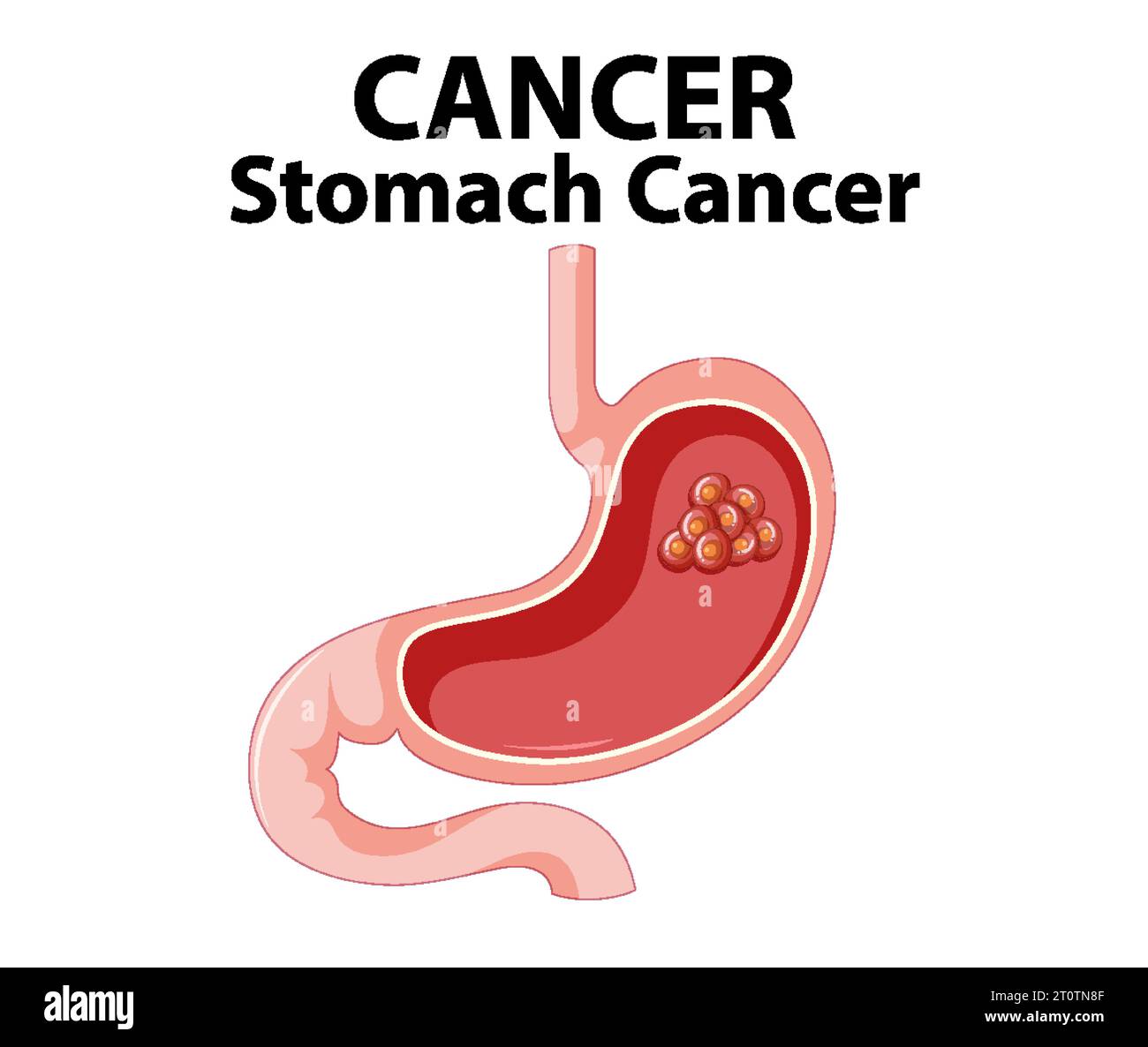Cartoons Of Stomach Cancer 20,264,403 Stomach Cancer Stock