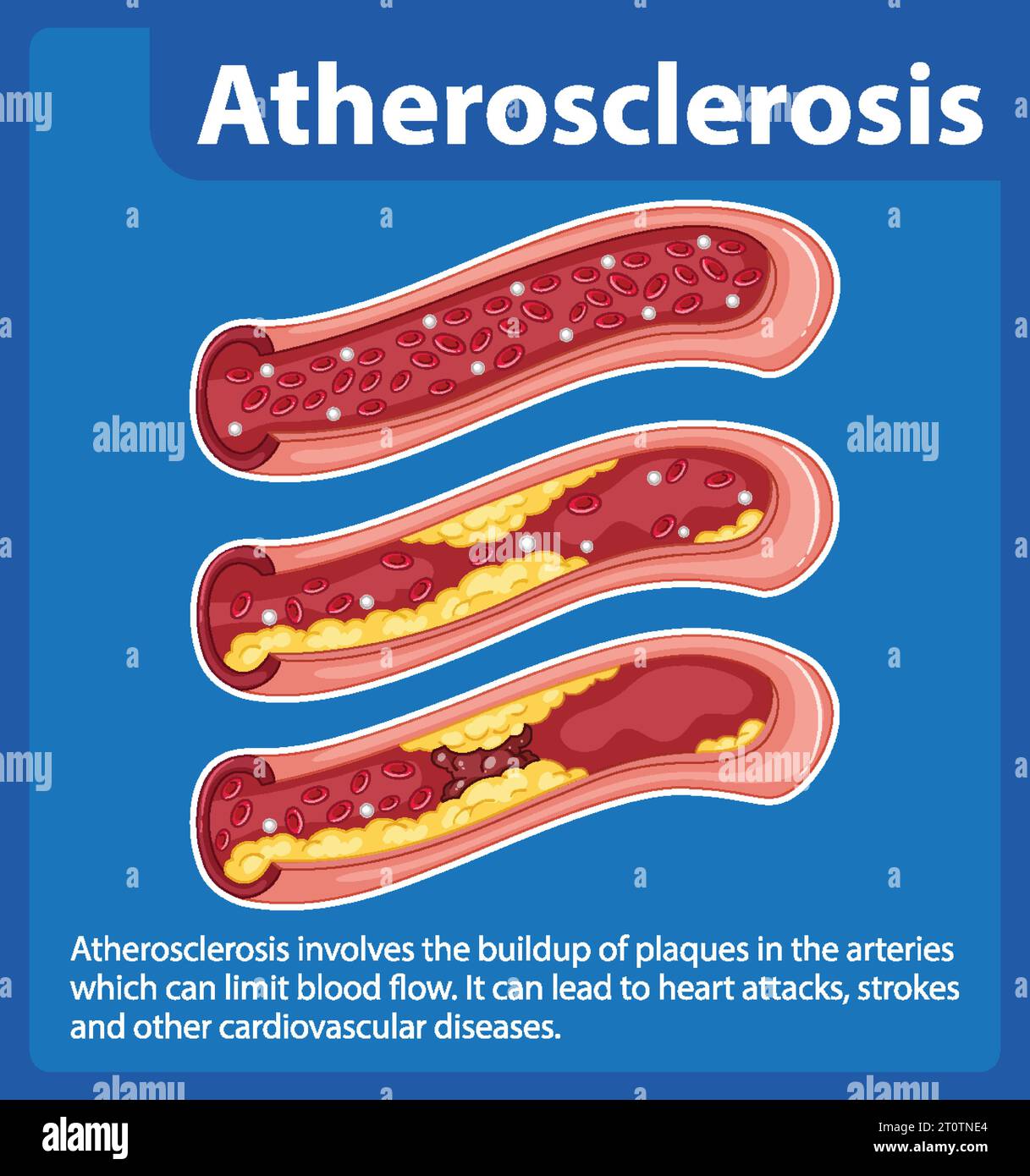 Learn about heart health and the development of atherosclerosis through ...
