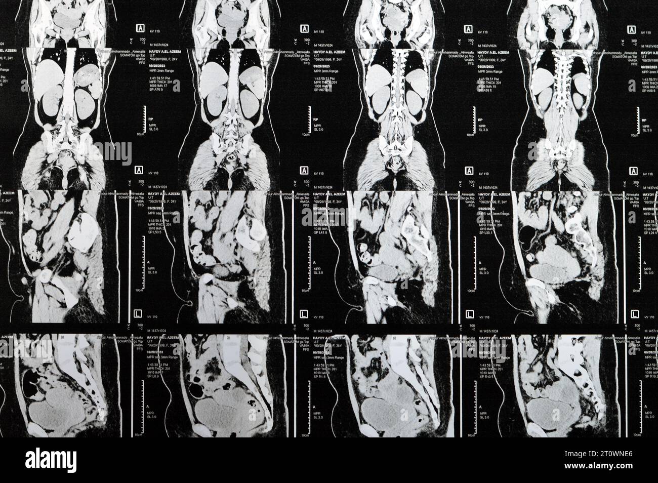 Cairo, Egypt, October 3 2023: Multi slice CT scan abdomen and pelvis ...