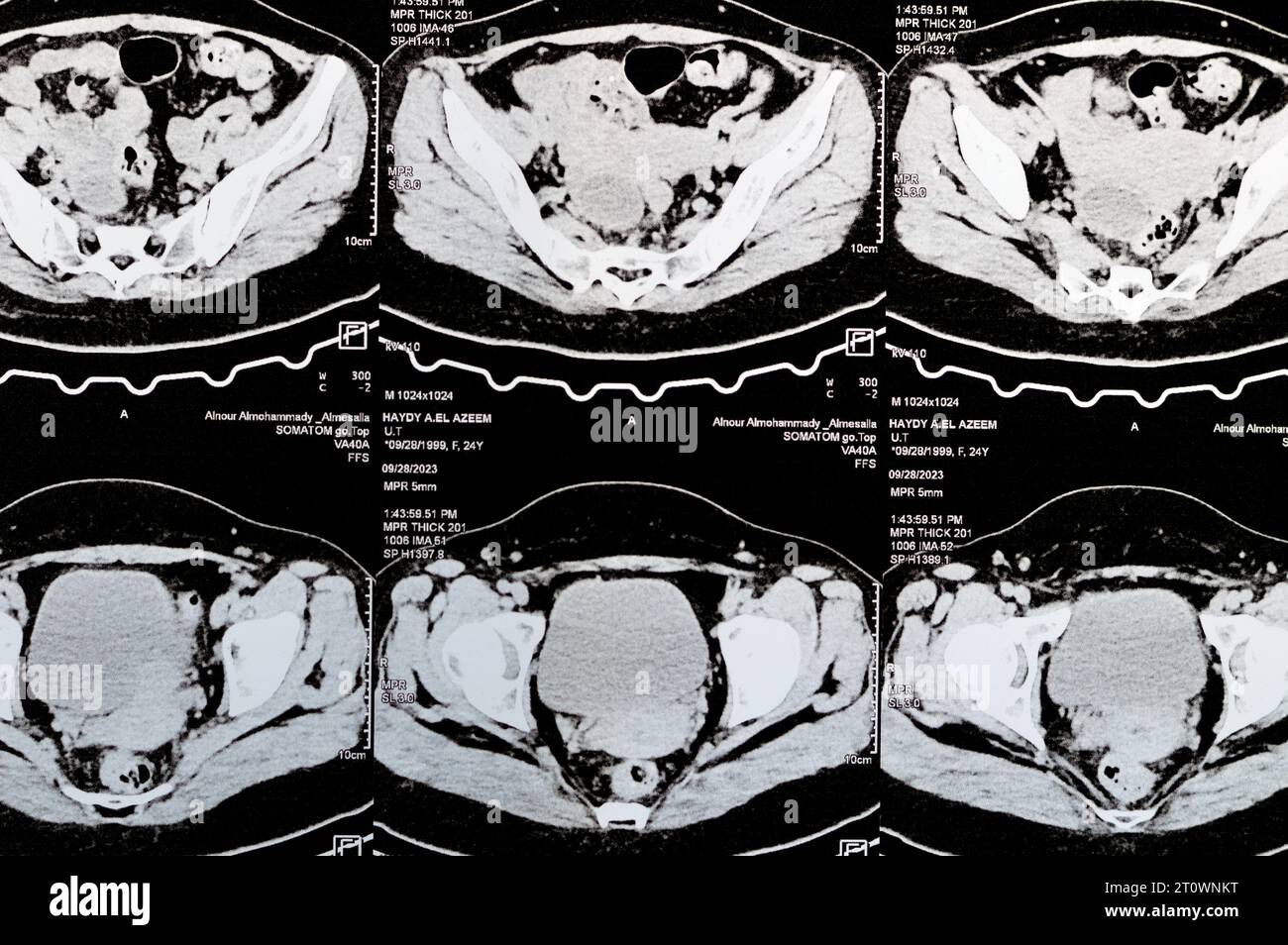 Cairo, Egypt, October 3 2023: Multi slice CT scan abdomen and pelvis ...