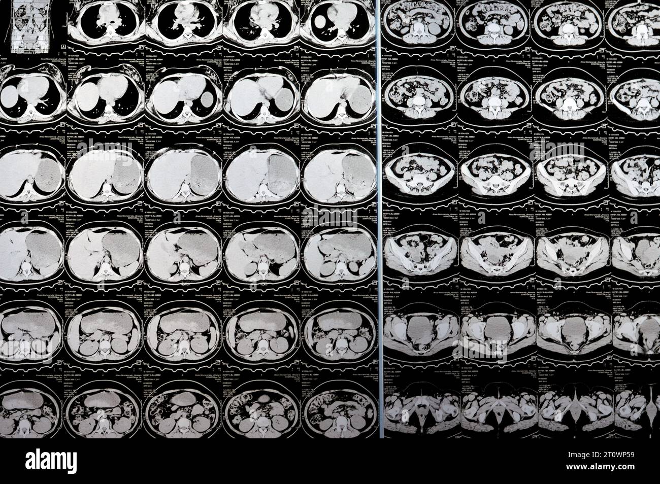 Cairo, Egypt, October 3 2023: Multi slice CT scan abdomen and pelvis ...
