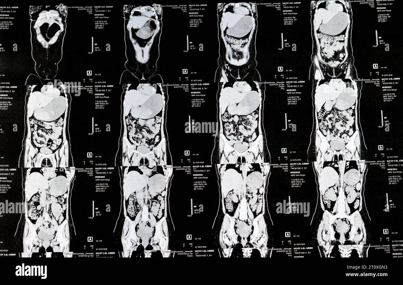 Cairo, Egypt, October 3 2023: Multi slice CT scan abdomen and pelvis ...