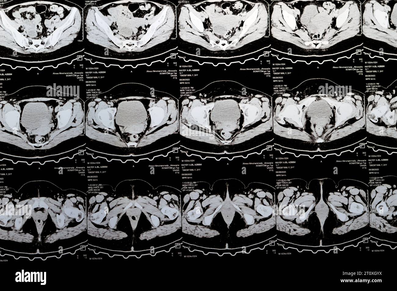 Cairo, Egypt, October 3 2023: Multi slice CT scan abdomen and pelvis ...