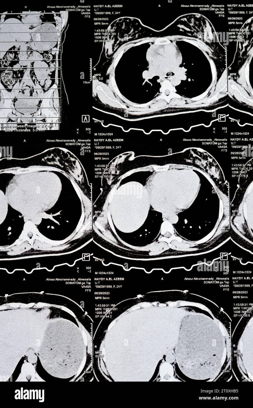 Cairo, Egypt, October 3 2023: Multi slice CT scan abdomen and pelvis ...