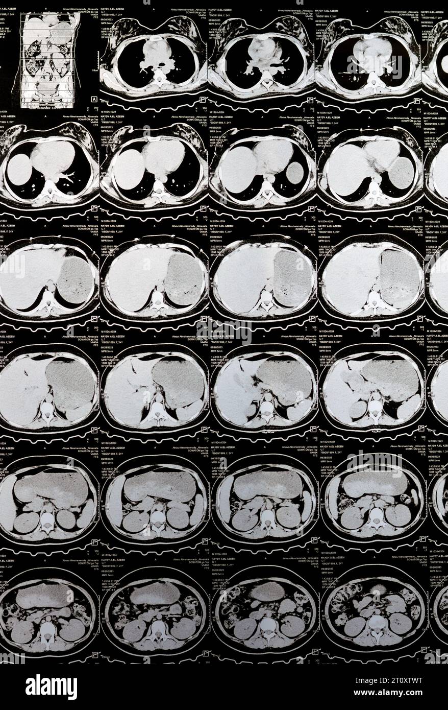 Cairo, Egypt, October 3 2023: Multi slice CT scan abdomen and pelvis ...