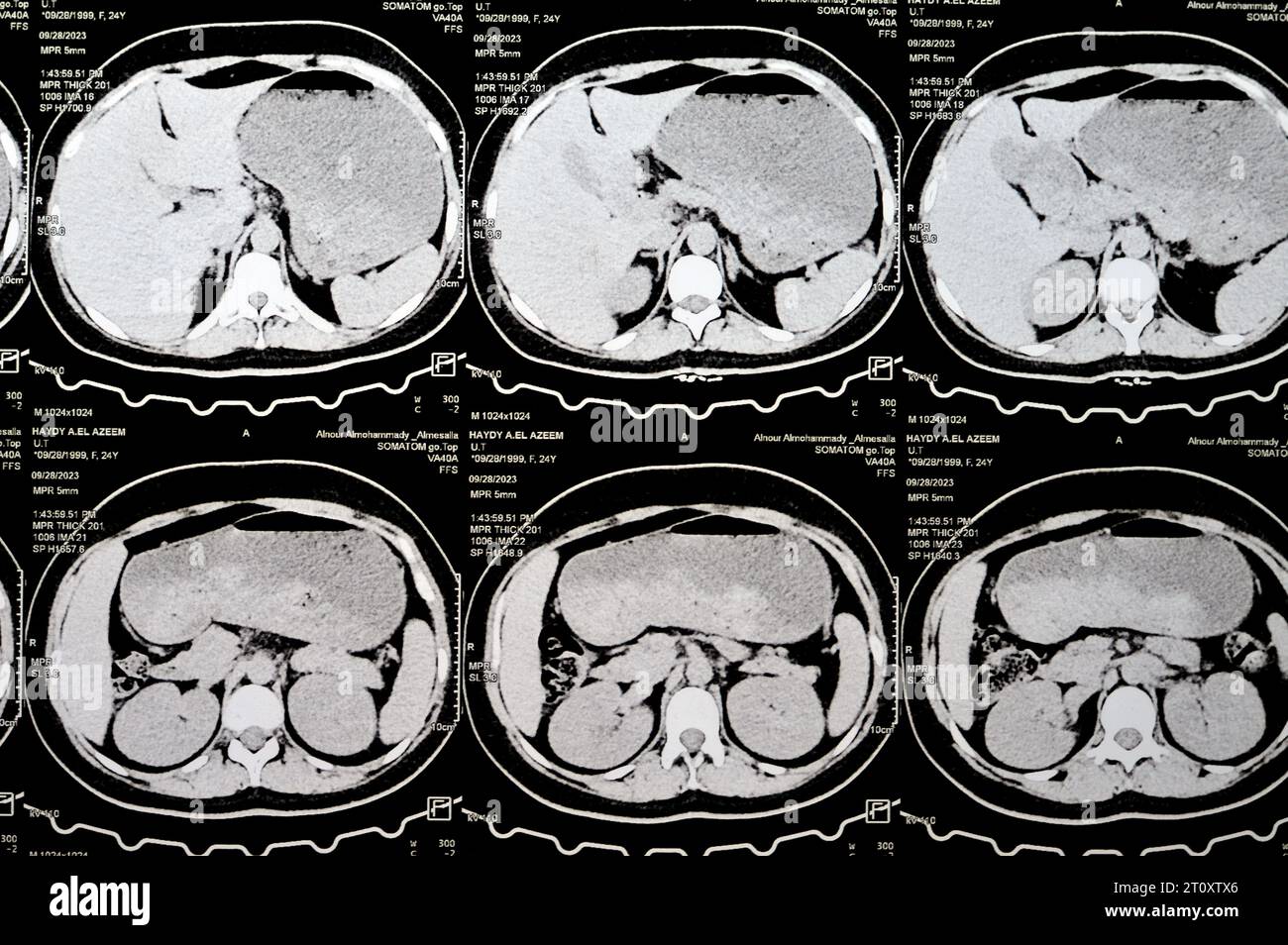 Cairo, Egypt, October 3 2023: Multi slice CT scan abdomen and pelvis ...