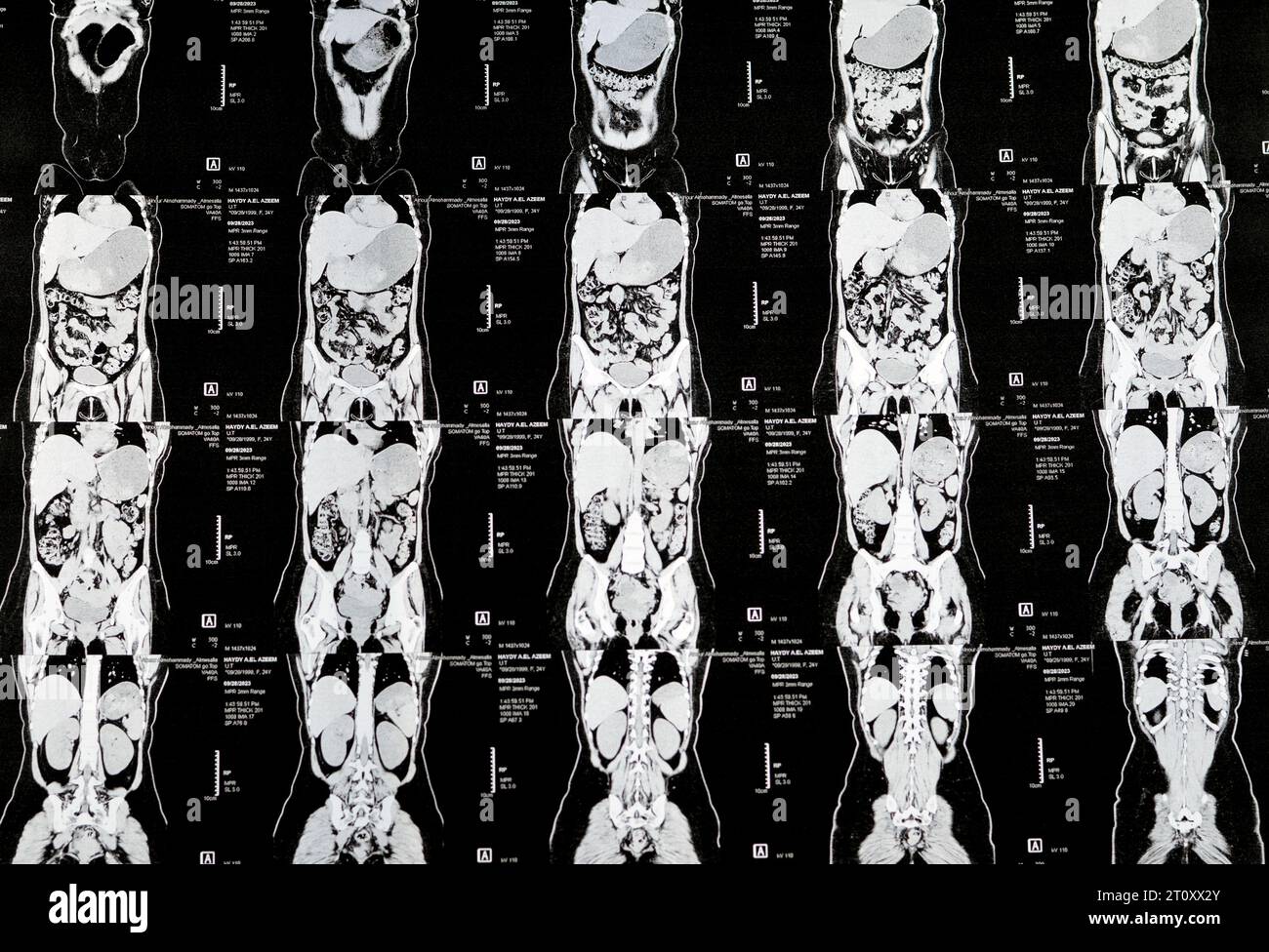 Ct scan abdomen hi-res stock photography and images - Alamy Ct scan abdomen hi-res stock photography and images - Alamy
