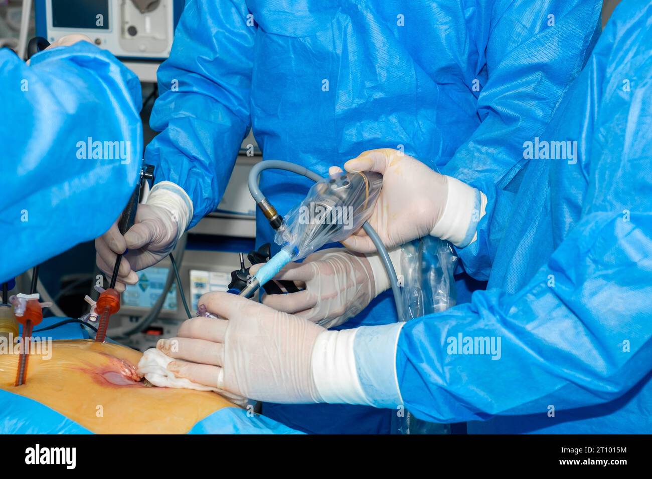 A team of doctors performs laparoscopic surgery in the operating room. Surgeons' hands hold ...