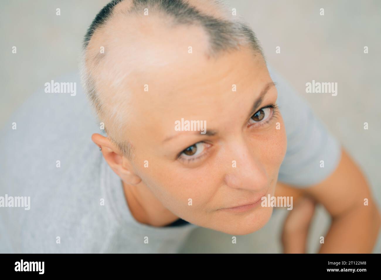 Real alopecia areata in a young girl. A bald head in a person. Diffuse ...