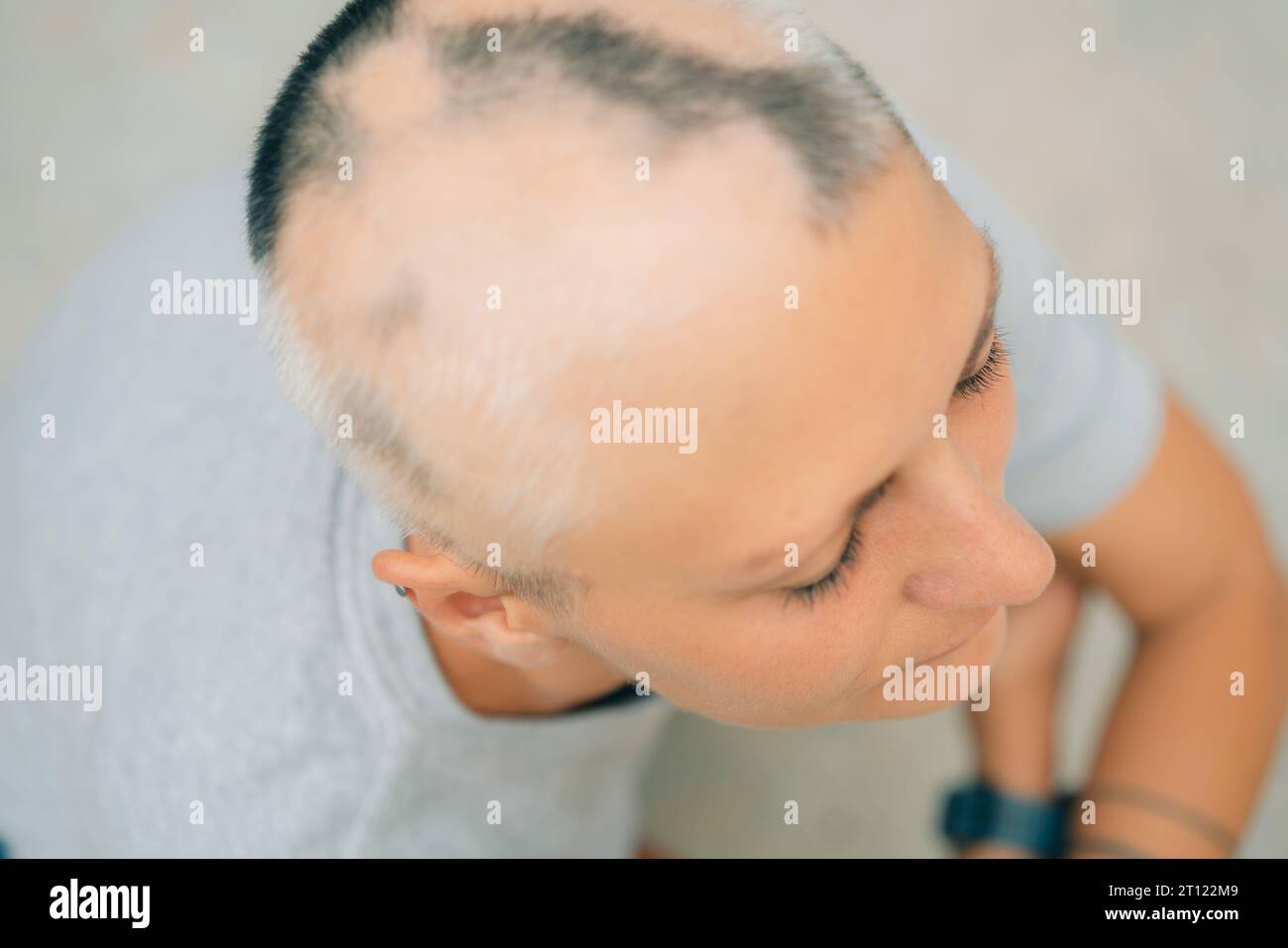 Real alopecia areata in a young girl. A bald head in a person. Diffuse ...