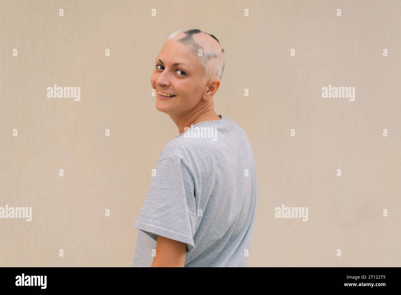 Real alopecia areata in a young girl. A bald head in a person. Diffuse ...