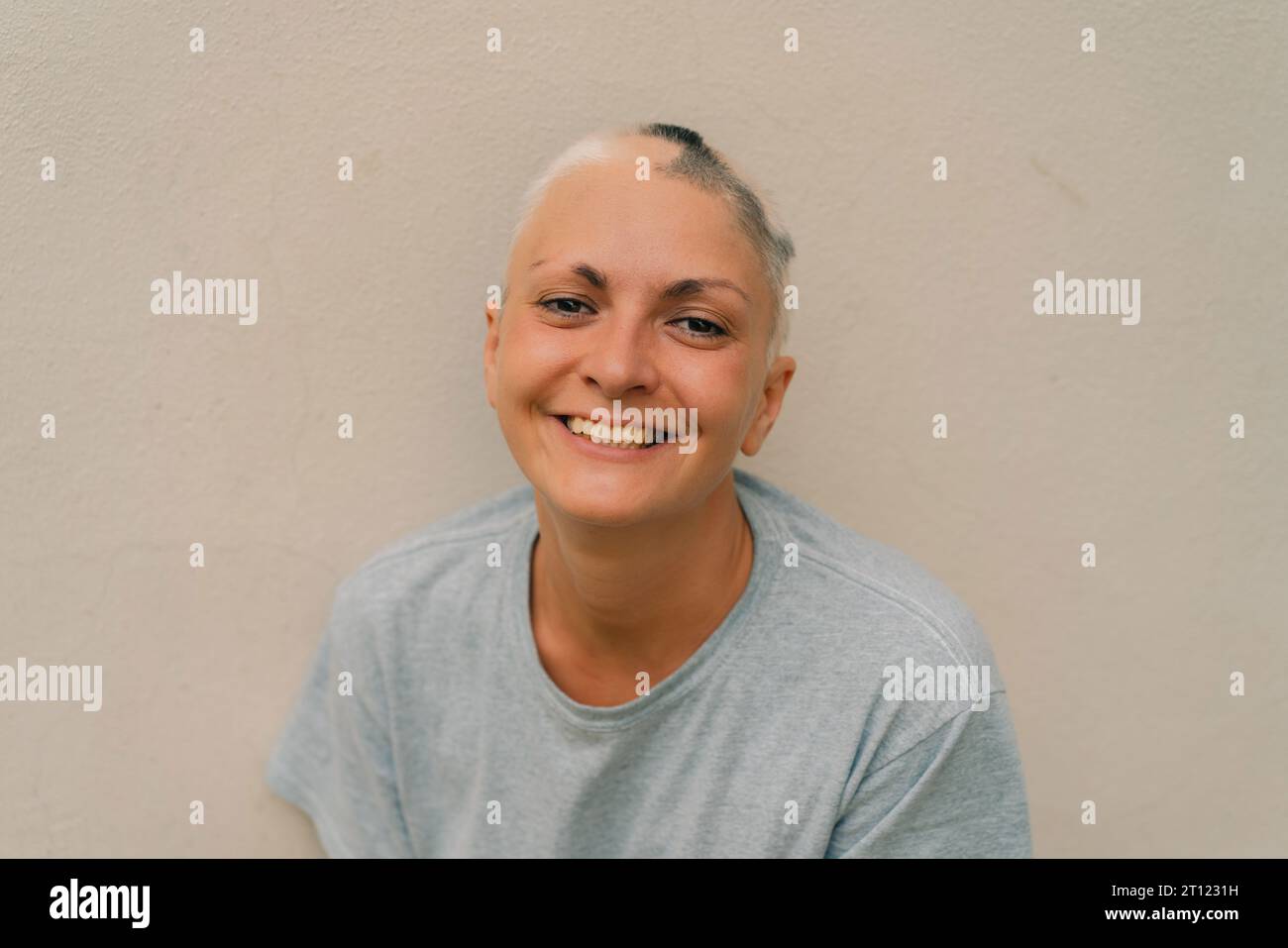 Real alopecia areata in a young girl. A bald head in a person. Diffuse ...