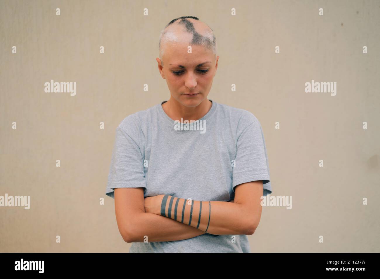 Real alopecia areata in a young girl. A bald head in a person. Diffuse ...