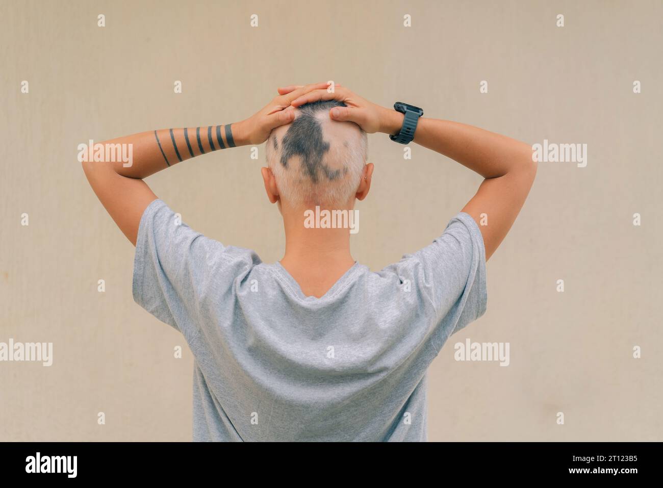 Real alopecia areata in a young girl. A bald head in a person. Diffuse ...