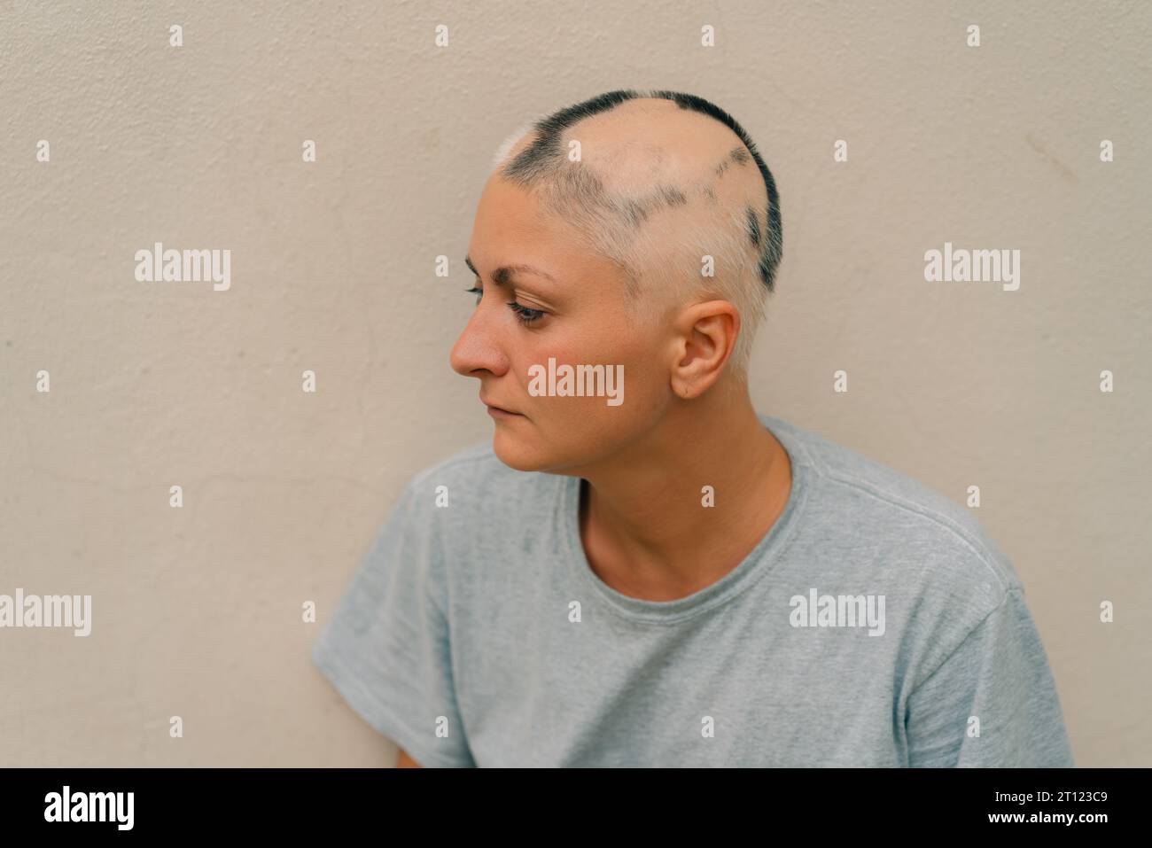 Real alopecia areata in a young girl. A bald head in a person. Diffuse ...