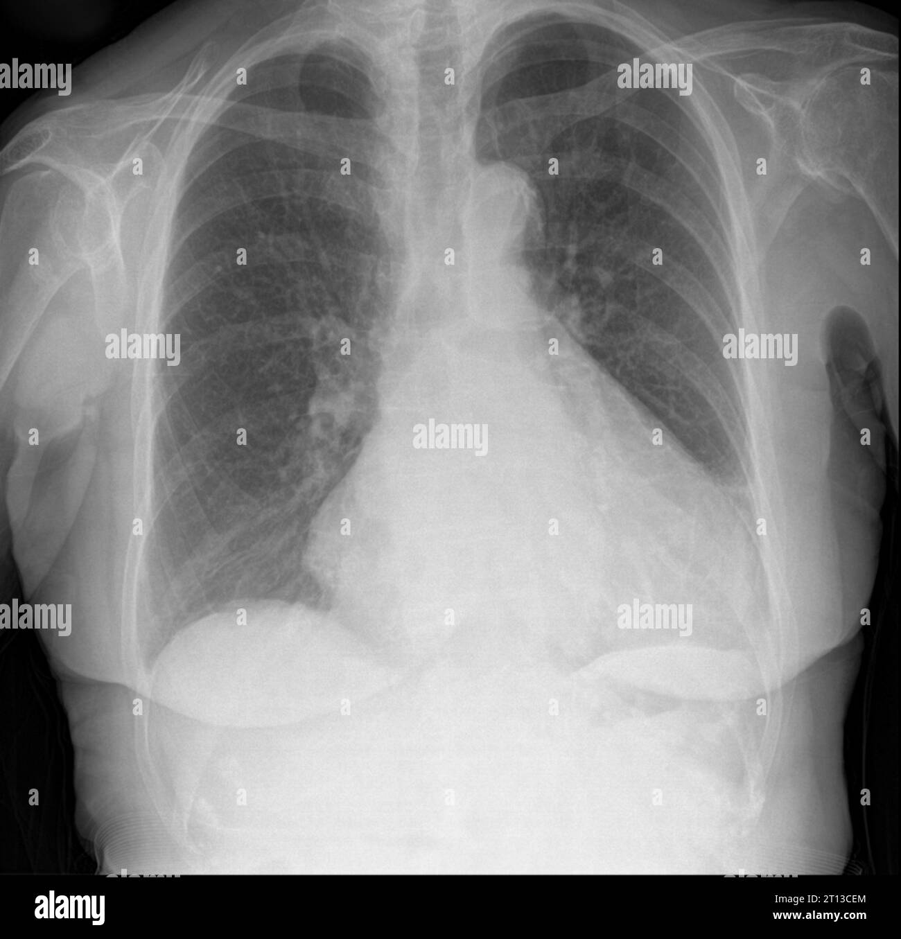 Frontal X-ray of the chest of a 97 year old female patient with an ...