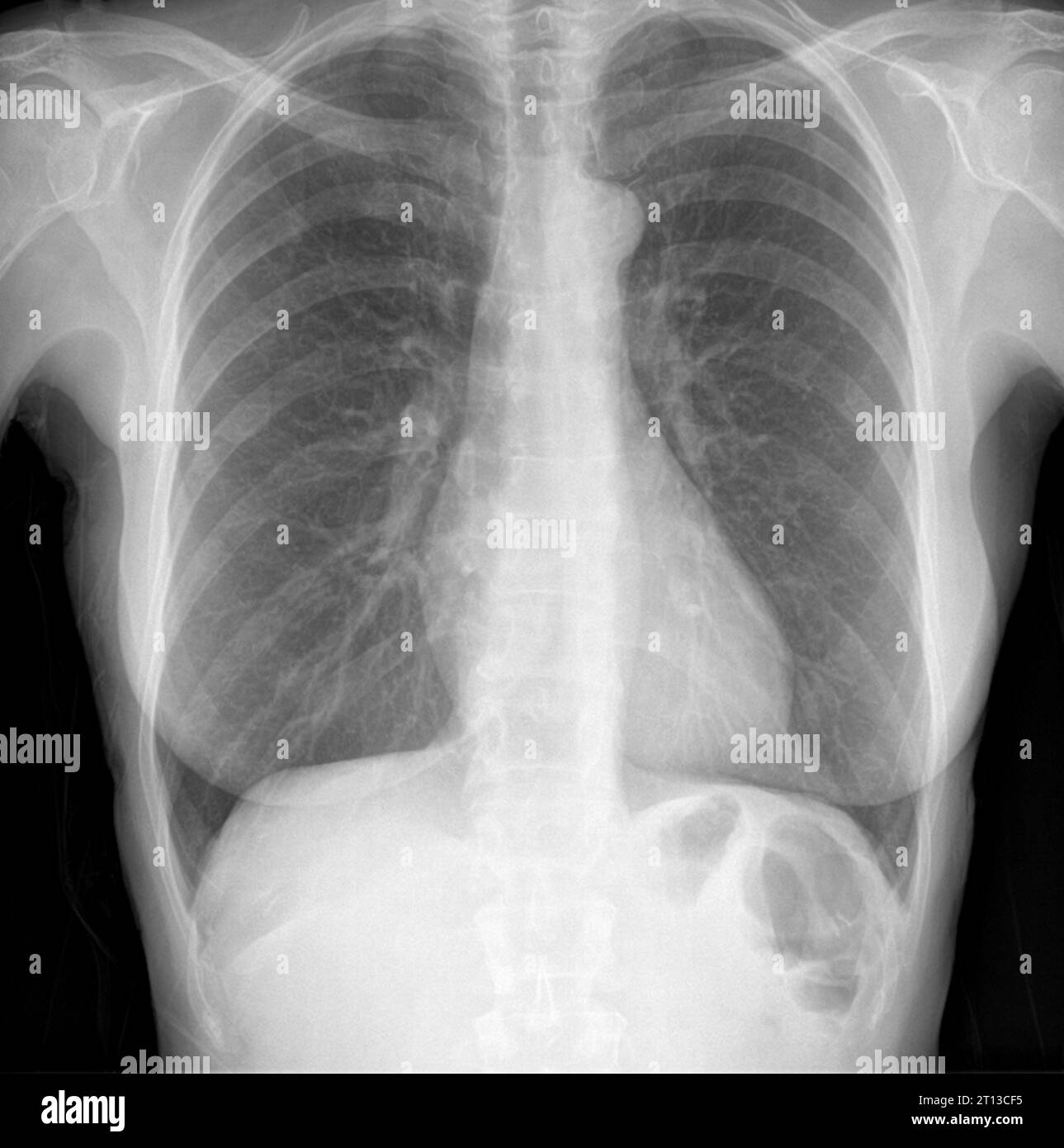 X-ray of the healthy chest of a 60 year old female patient Stock Photo ...
