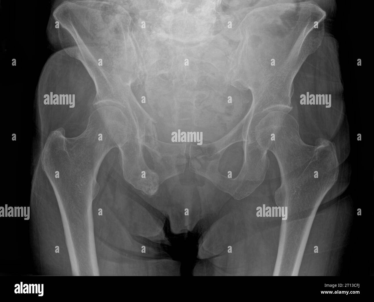 X-ray of the pelvis of a 73 year old female patient with a comminuted ...