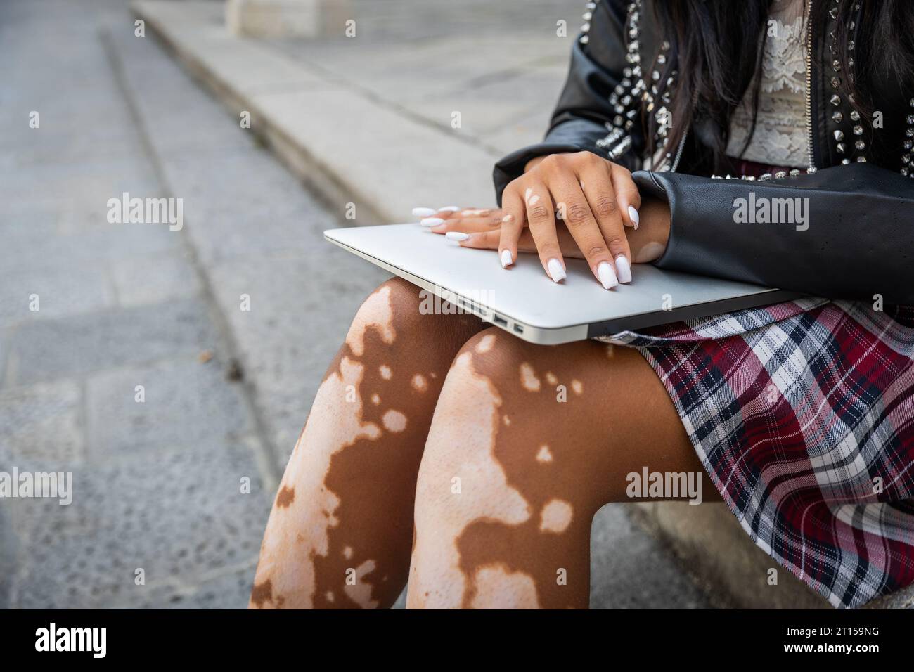 Chronic skin disease hi-res stock photography and images - Alamy