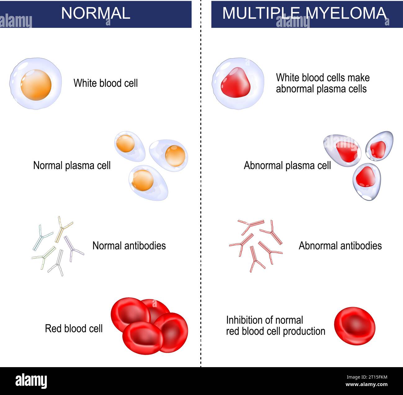 Multiple myeloma plasma cells hi-res stock photography and images - Alamy