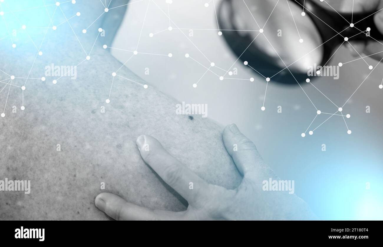 Dermatologist examining skin of patient shoulder with magnifying glass ...