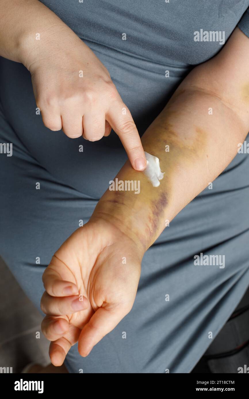 Close up photo of woman's hand is applying medical cream at bruise ...
