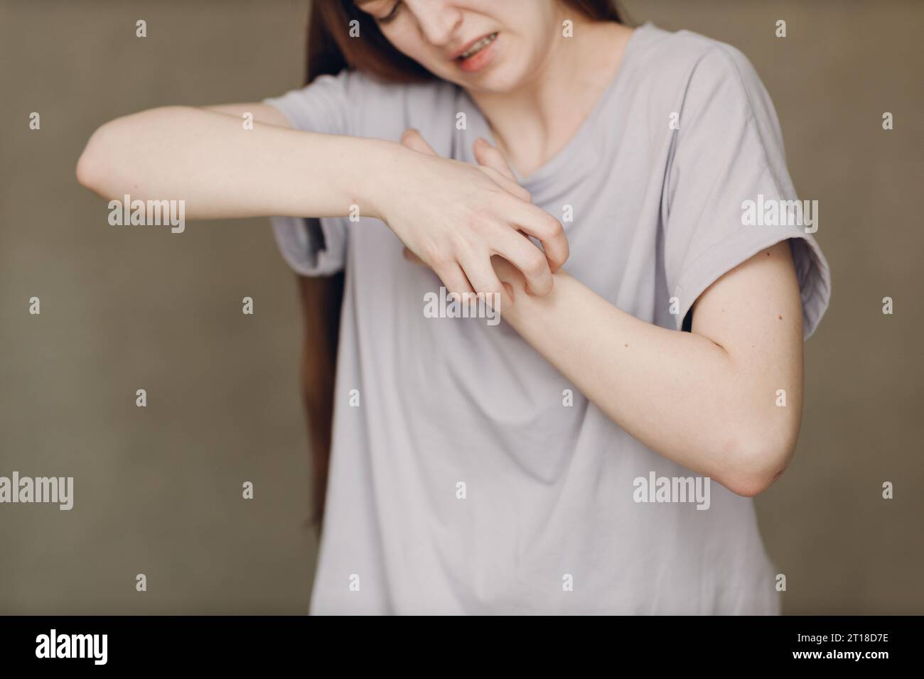 Allergy dermatology scabies itches hand skin problem woman Stock Photo ...