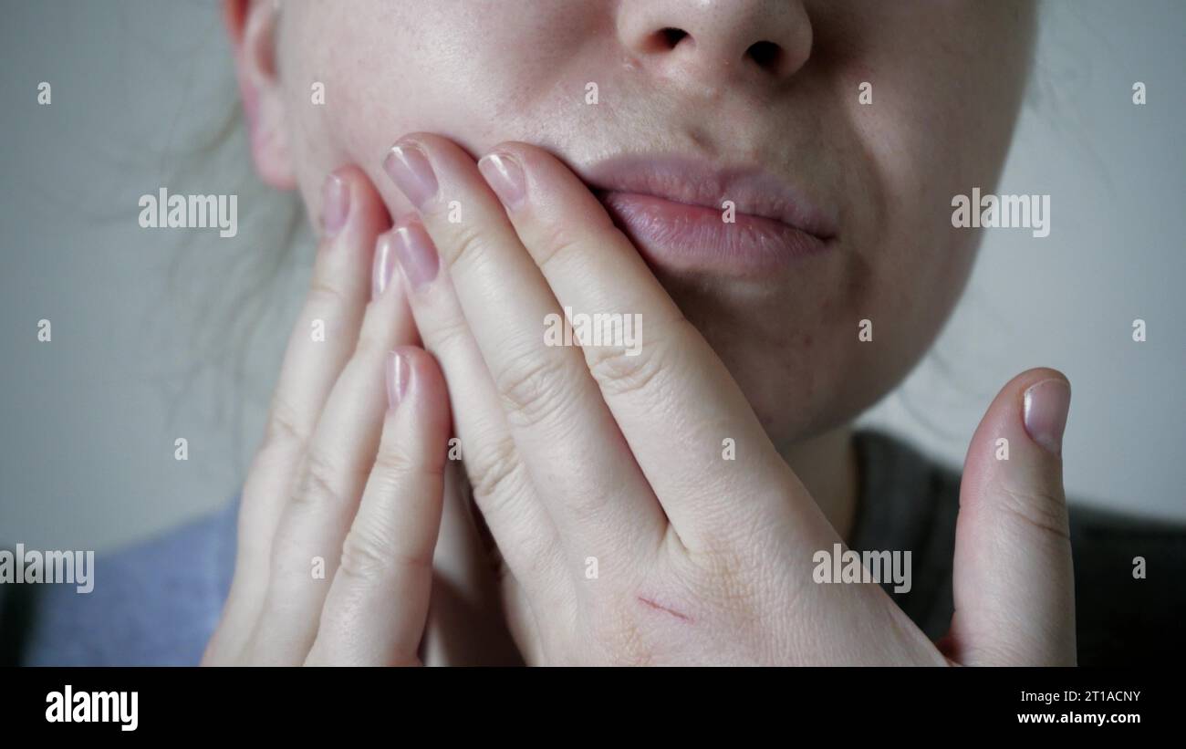 Close up of skin problems, unhealthy skin with acne and pimples. Porous ...