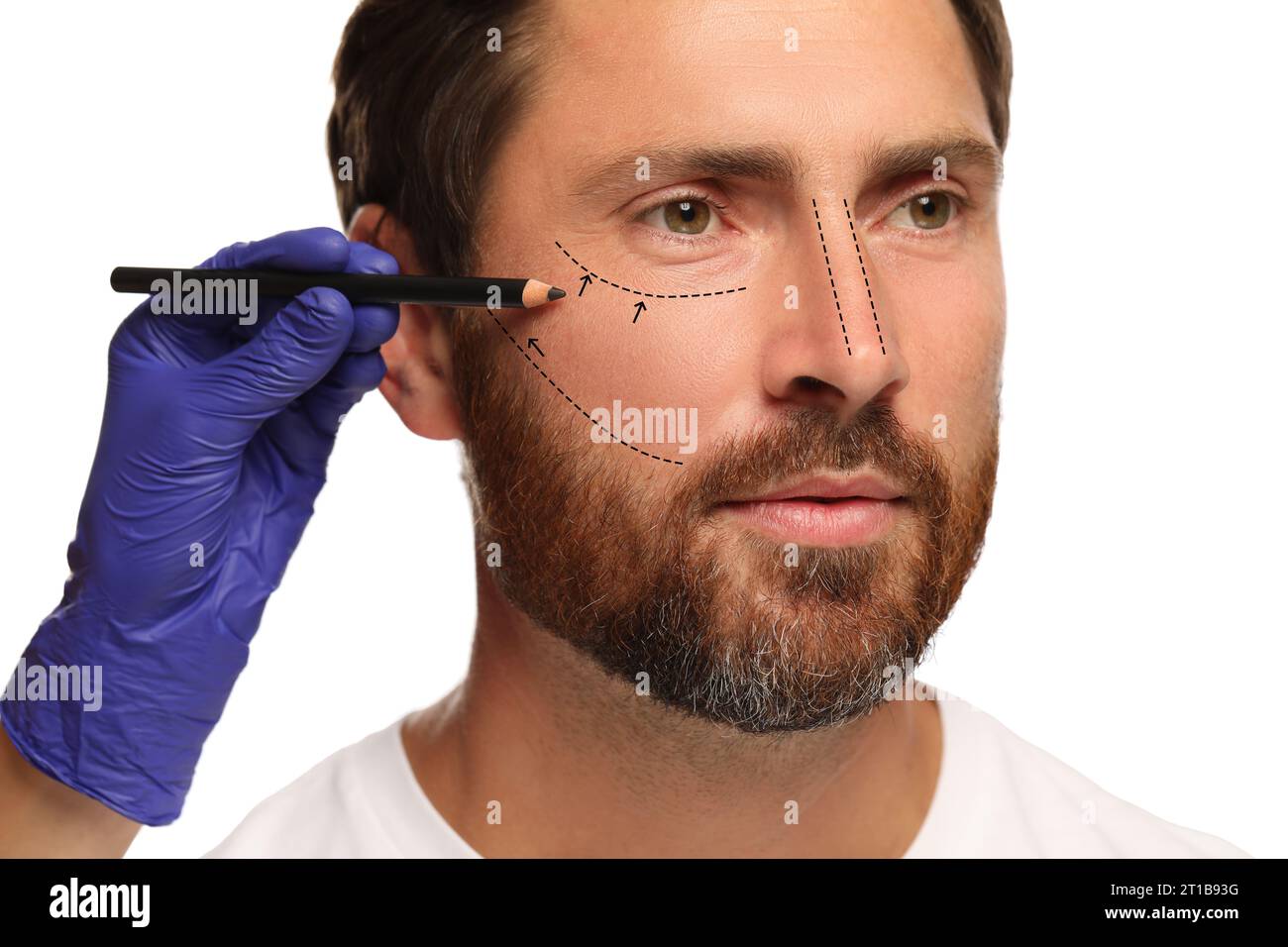 Man preparing for cosmetic surgery, white background. Doctor drawing ...