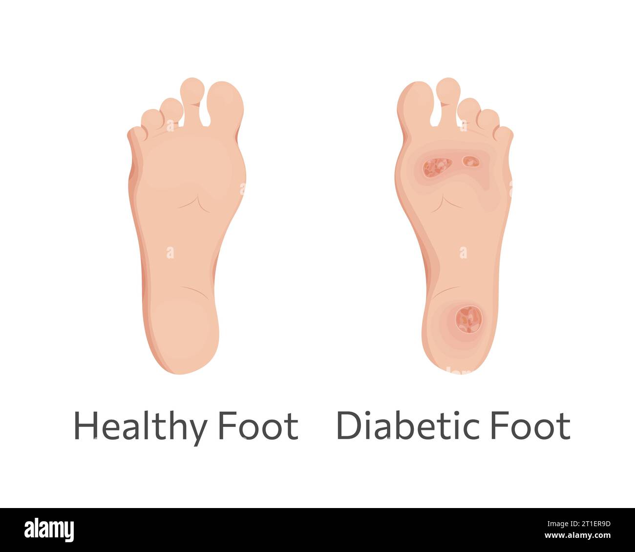 Necrosis foot Stock Vector Images - Alamy