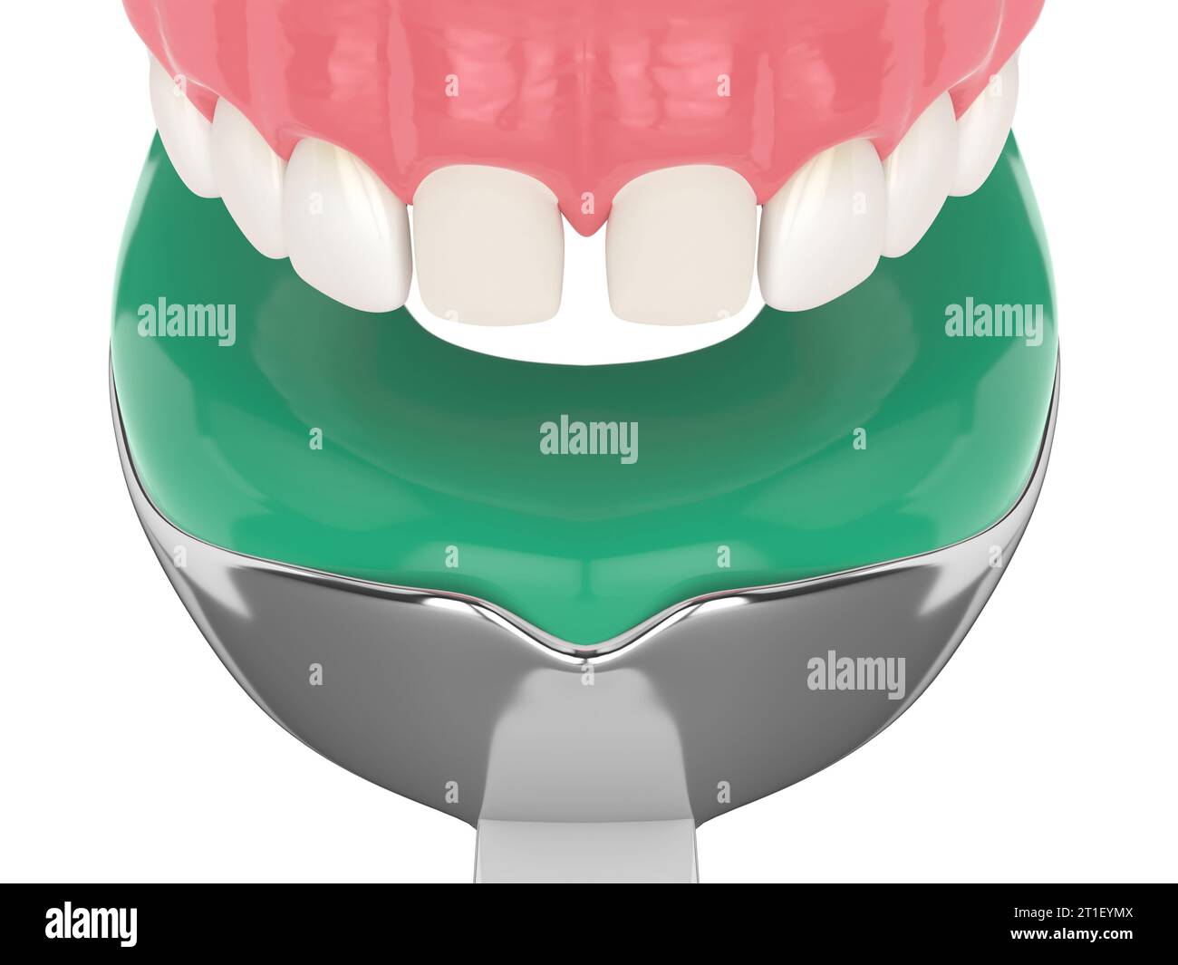 3d render of upper jaw with dental impression tray over white ...