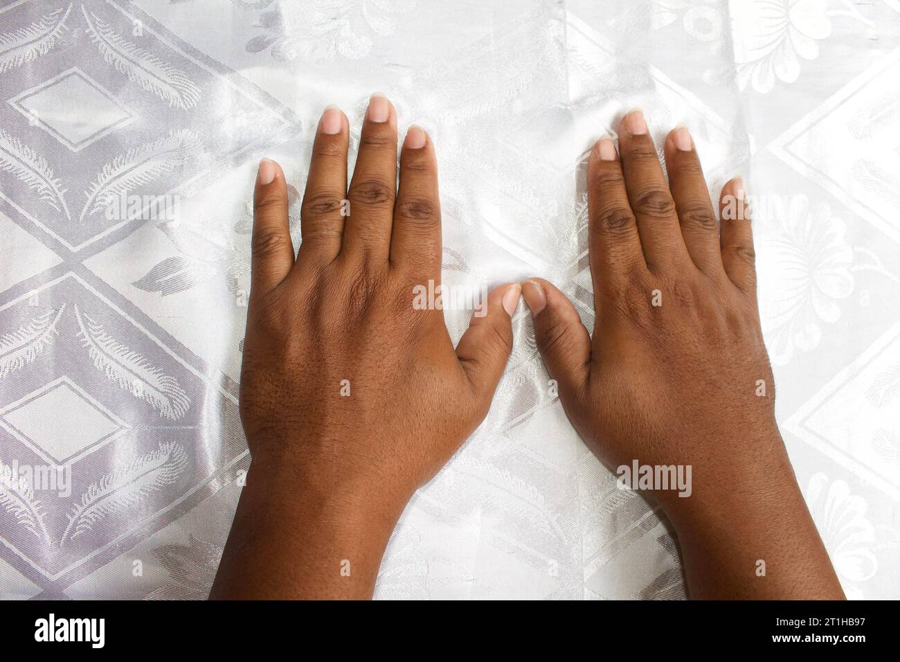 Swelling on hands hi-res stock photography and images - Alamy