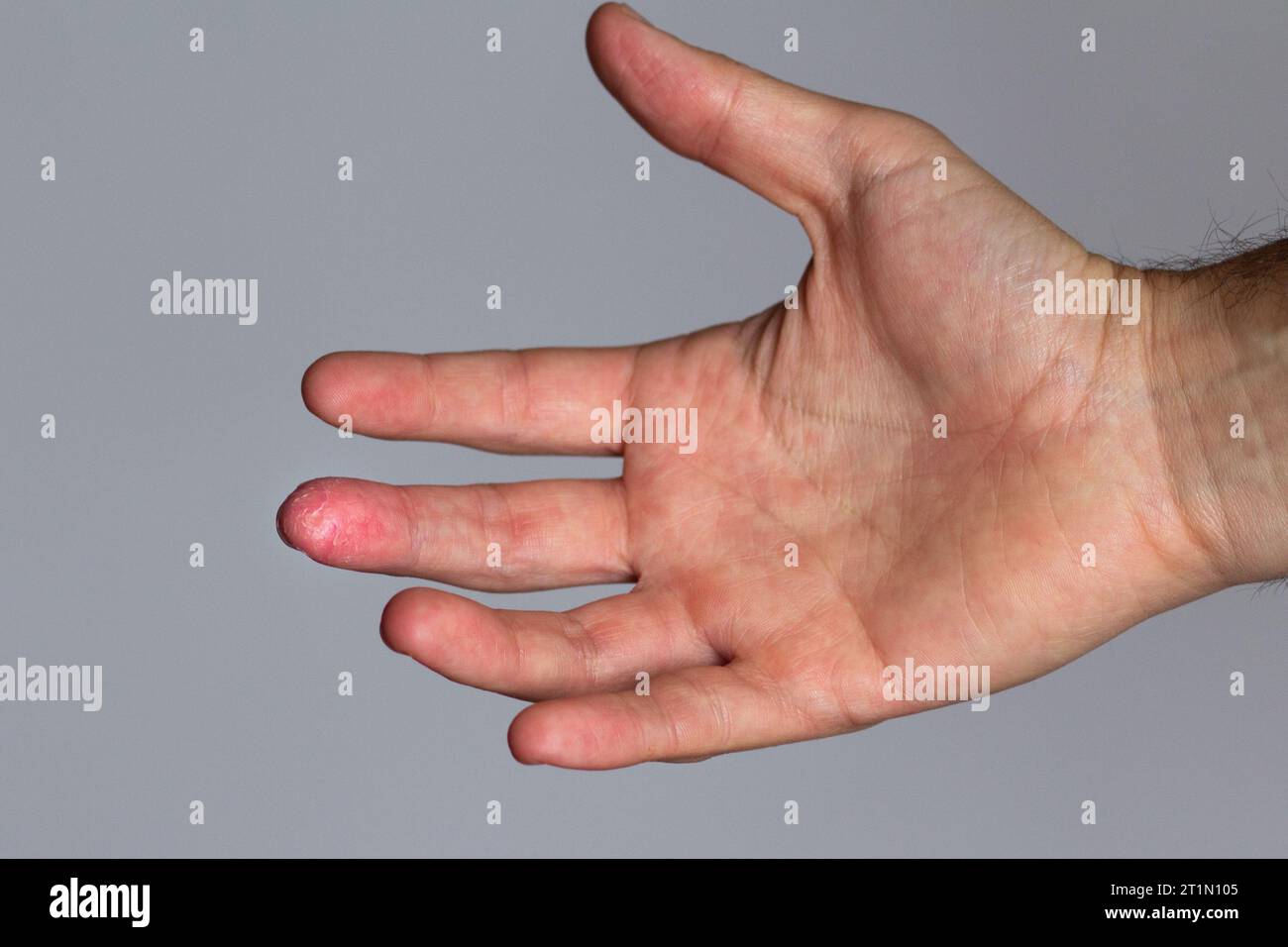 Dermatitis hi-res stock photography and images - Alamy