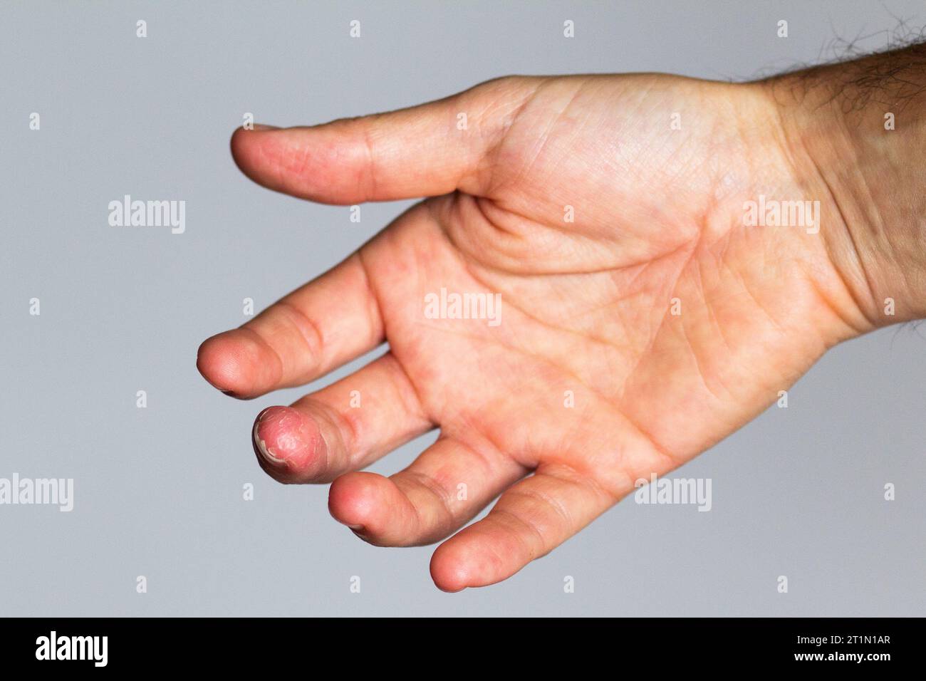 Hand with contact dermatitis in one finger Stock Photo - Alamy