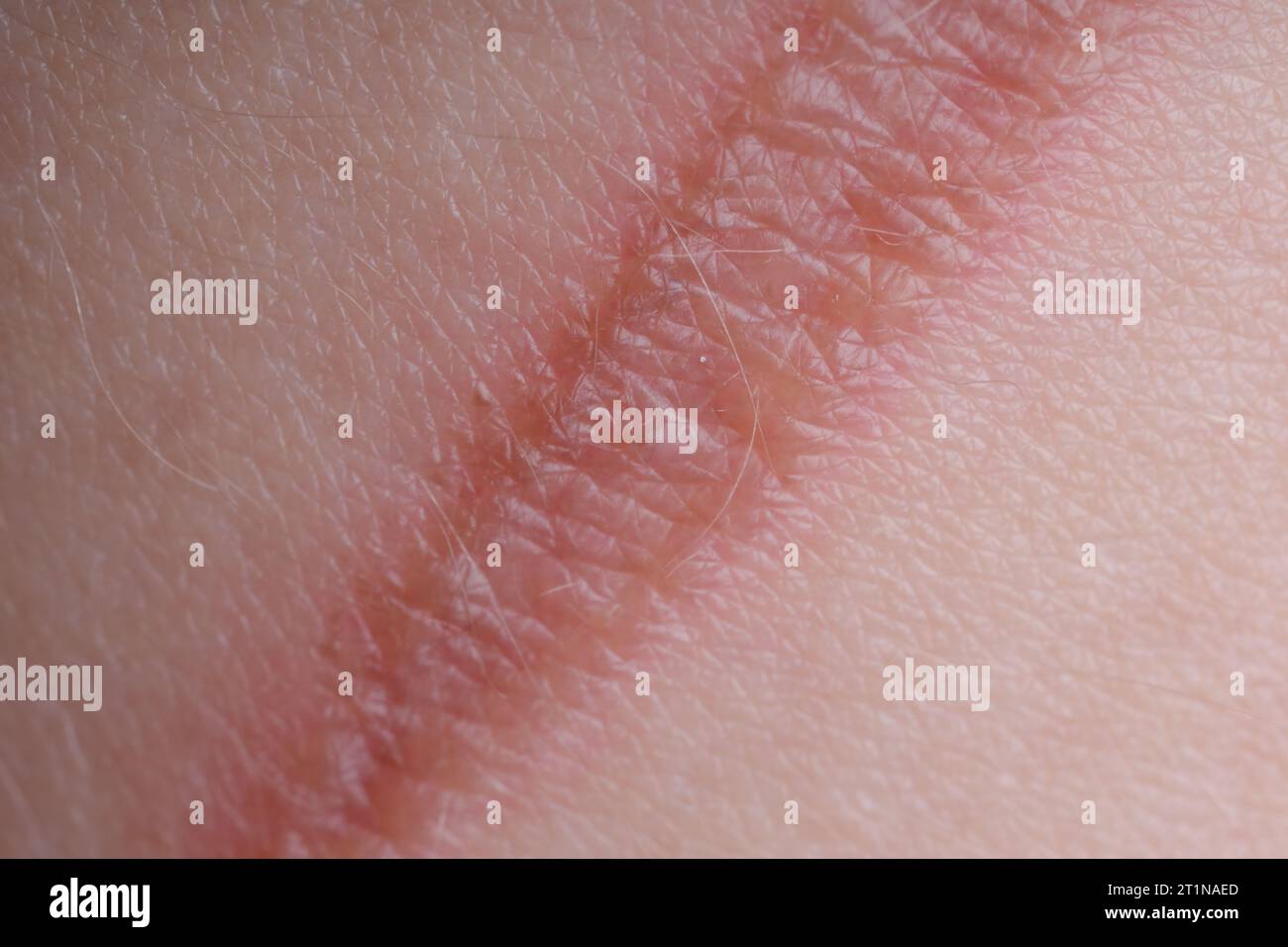 Texture of skin with scar as background, macro view Stock Photo - Alamy